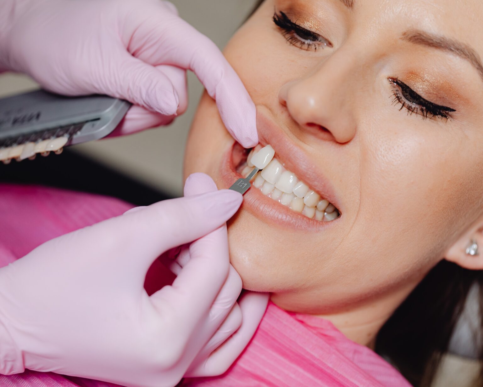 Emax Veneers - 180 One Eighty Clinic